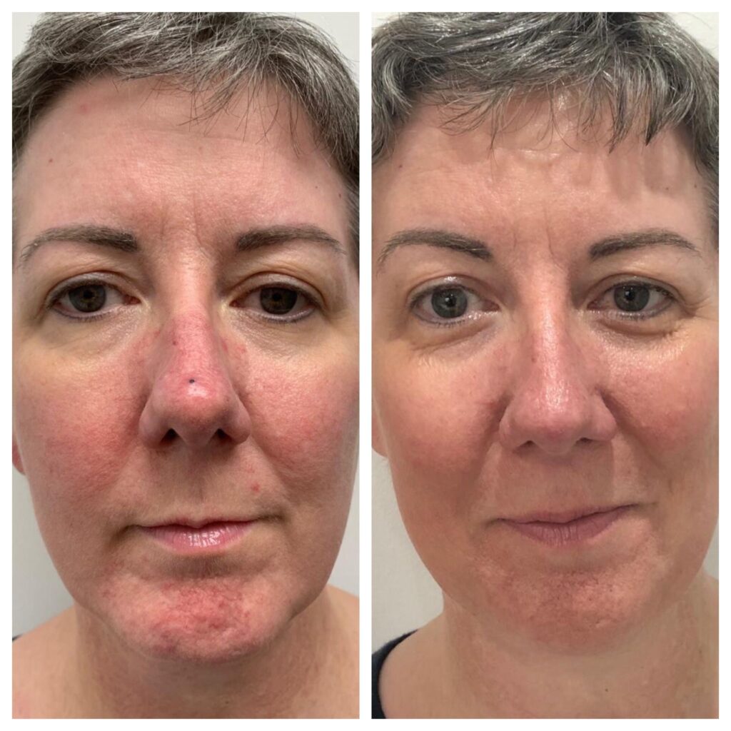 WOW Fusion Treatments Kent • Laser & Aesthetic Clinic