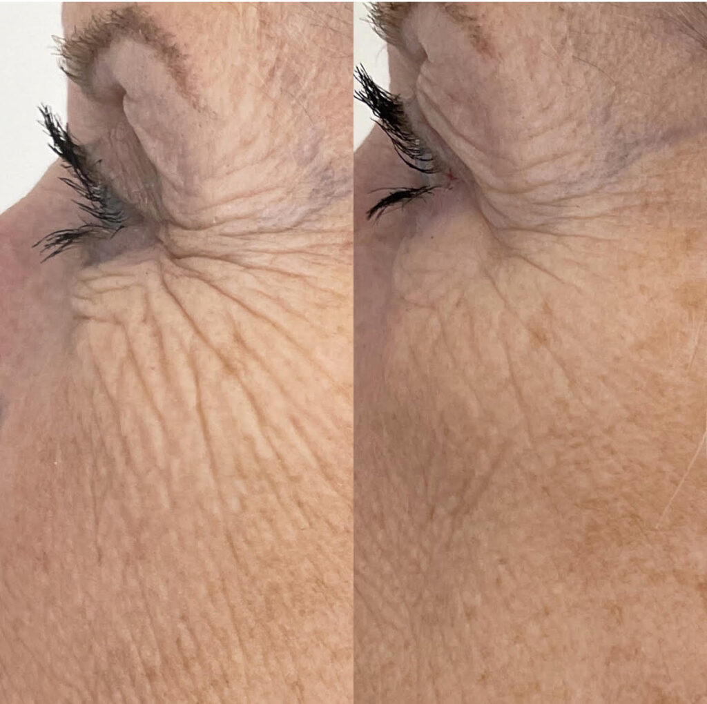 3D Dermaforce • Dermaforce Treatments In Gravesend, Kent